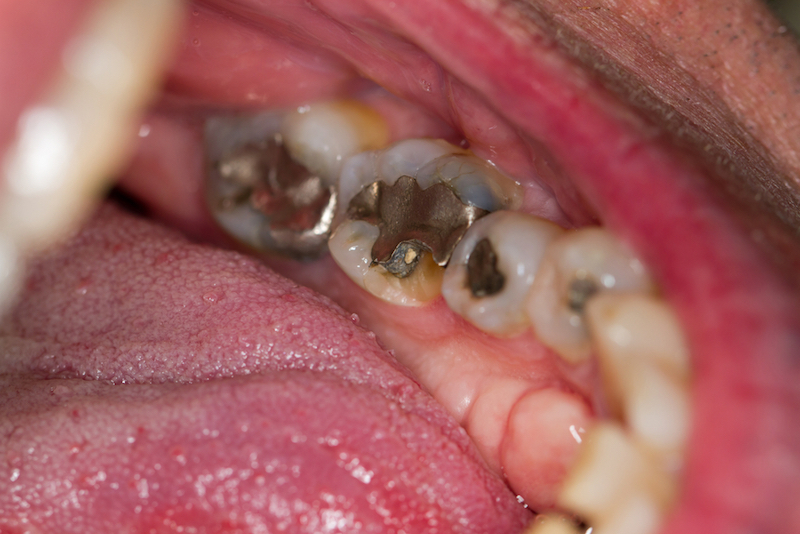 Dental Fillings Merrick NY | Progressive Dentistry | Tooth Fillings