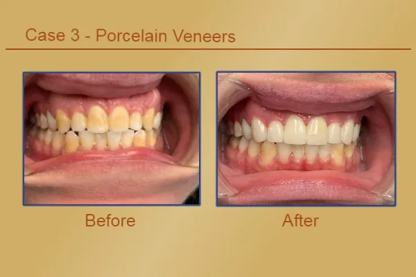 Veneers Before And After Buck Teeth